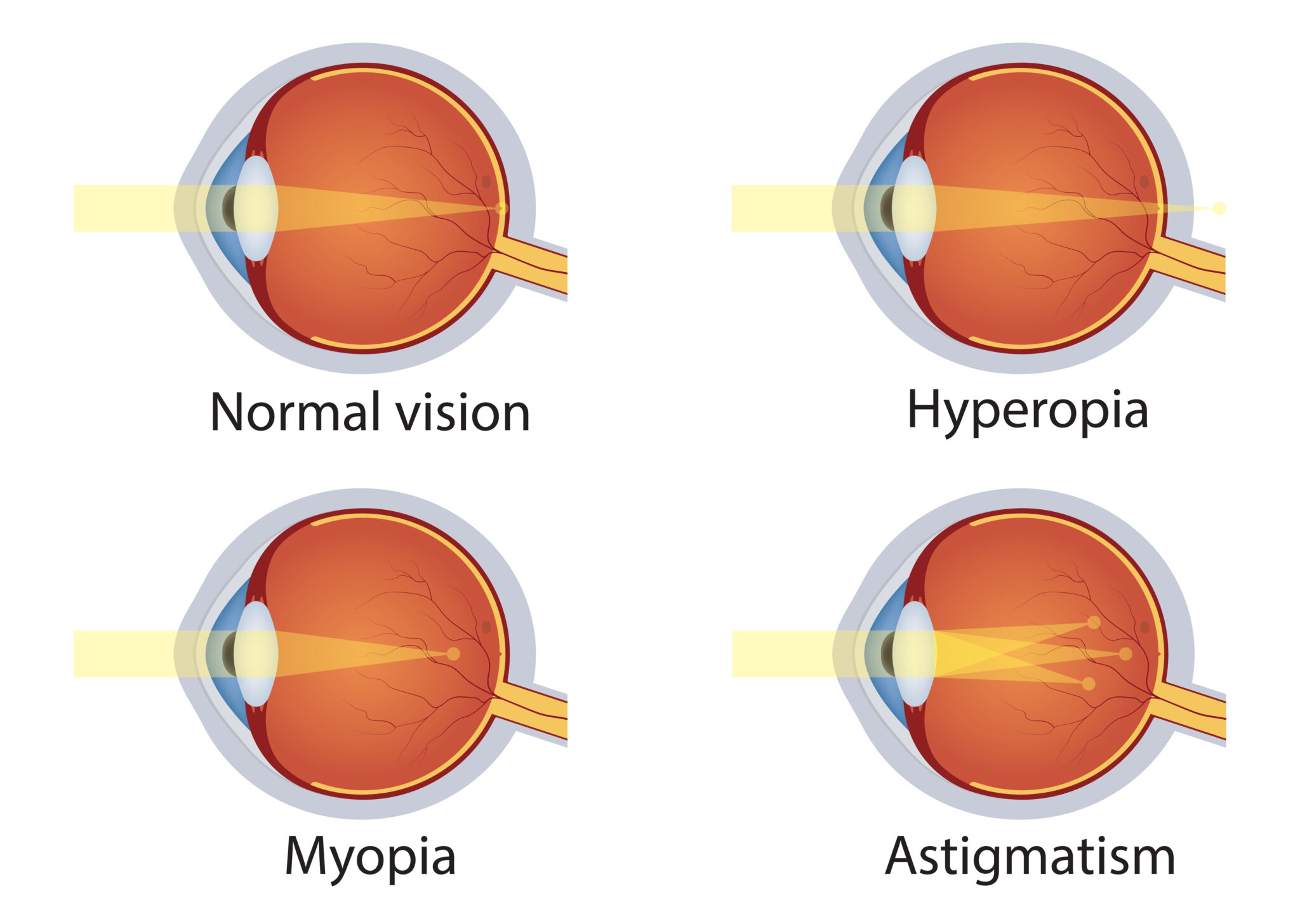Eye Exam Albuquerque | Eye Doctor | What is an Eye Refraction?